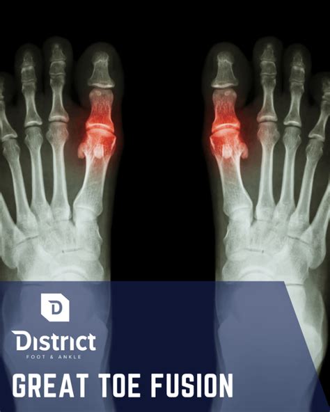 Great Toe Joint Fusion Surgery Alexandria VA Podiatrist