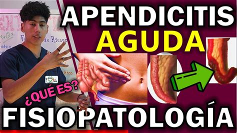 APENDICITIS AGUDA FISIOPATOLOGÍA GuiaMed YouTube