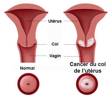 Cancer Du Col De L Ut Rus Sympt Mes Traitement D Finition