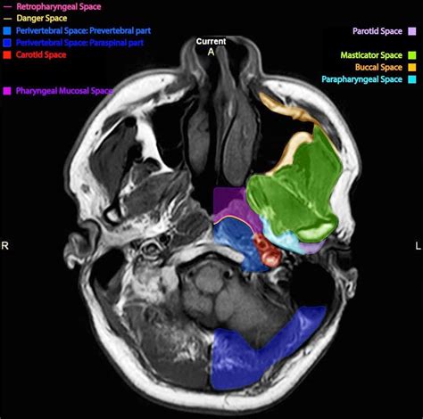 Giải Phẫu CT MRI Vùng Cổ Bài giảng CĐHA