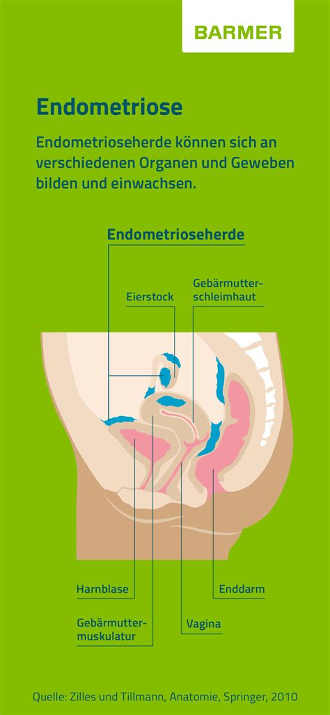 Endometriose Diagnose Und Behandlung Barmer