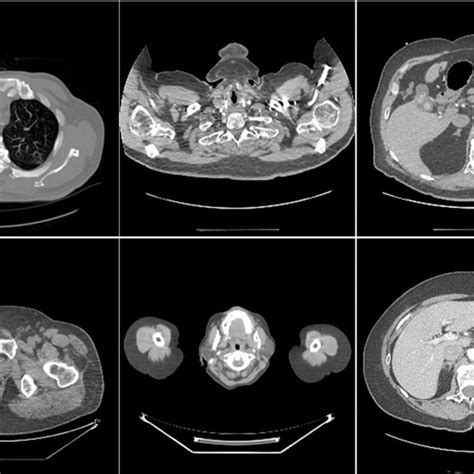pdf low dose ct with a residual encoder decoder convolutional neural network