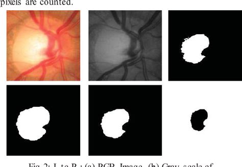 Figure From Detection Of Glaucoma Using Retinal Fundus Images