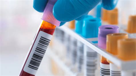 Tout Savoir Sur Le Pr L Vement Veineux Avf Biomedical