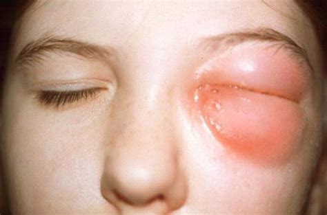 Orbital Cellulitis Pictures Treatment Symptoms Causes The Best