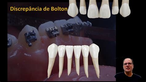 Discrepância de Bolton YouTube