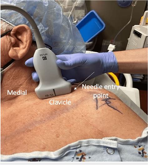 Figure From Comparison Of Supraclavicular Regional Nerve Block Versus