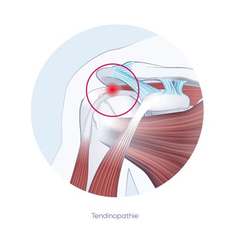 Tendinopathie de la Coiffe des Rotateurs Chirurgie de lépaule et du