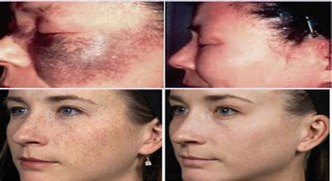 Cómo deshacerse de las manchas pecas y hiperpigmentación con tan sólo