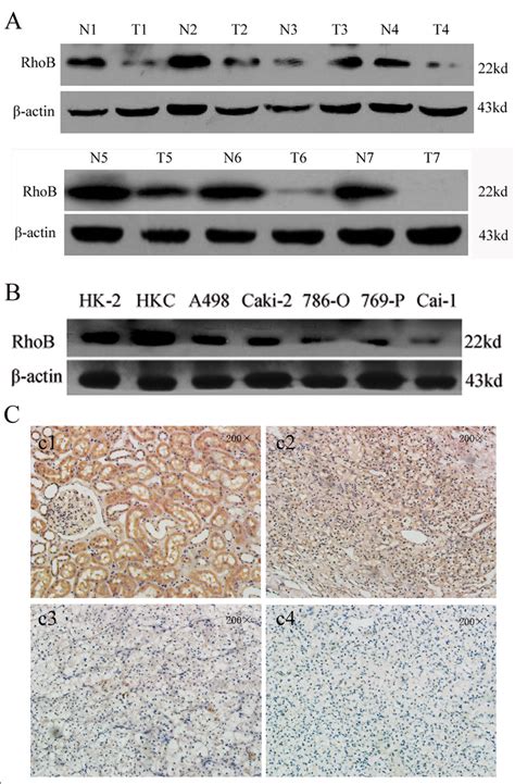 RhoB Expression Is Downregulated In CcRCC Tissues And Cell Lines A