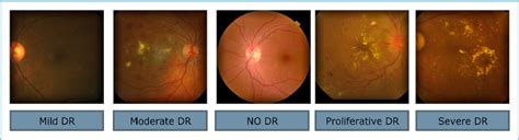 figure 1 from enhancing diabetic retinopathy classification using deep learning semantic scholar
