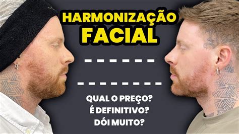 HARMONIZAÇÃO FACIAL MASCULINA Antes E Depois Respondendo Dúvidas