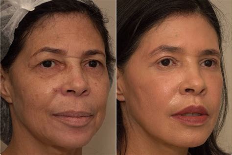 Peeling De Fenol Promete Rejuvenescer Anos Em Uma Sess O