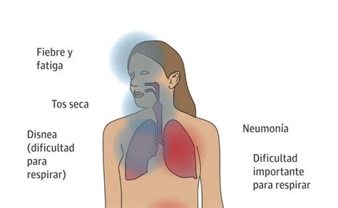 Neumonía los síntomas más claros de que padeces esta enfermedad