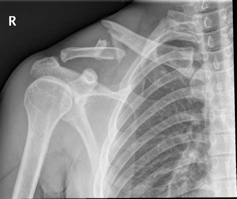 Clavicle Fractures The Shoulder And Elbow Clinic