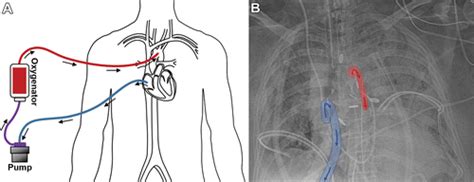 Vv Ecmo Cannula Placement