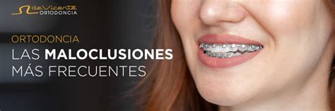 Ortodoncia las maloclusiones más frecuentes Clínica Dental De