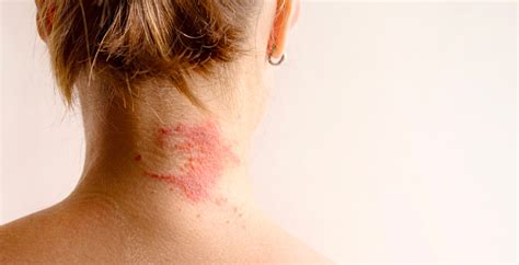 Dermatite atopica cosè e come riconoscerla L altra Medicina Magazine
