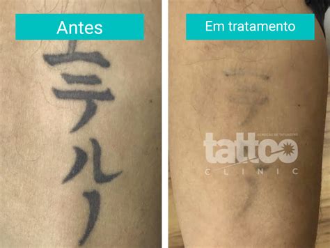 Remoção de Tatuagem a Laser Antes e Depois Tattoo Clinic