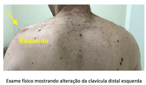 Luxação acrômio clavicular do ombro Dr Artur Utino Membro do grupo