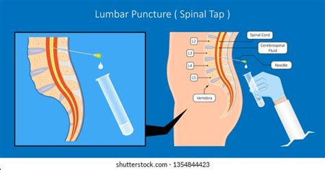 Coronary Artery Disease Cad Diagnosis Carotid