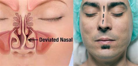 Deviated Septum Symptoms Causes Treatment Preventions All You Need To