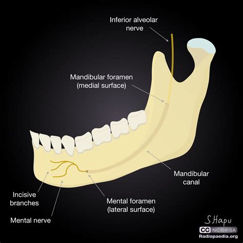 Radiopaedia Drawing Inferior Alveolar Nerve Of Mandibular Nerve