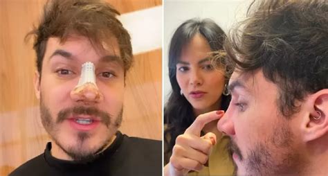 Confira O Resultado Da Cir Rgia Pl Stica Do Ex Bbb Eliezer