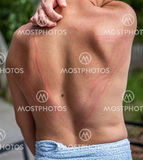 Dermatographic Urticaria On Back