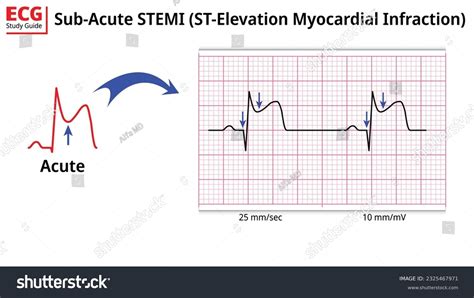 STEMI ST Elevation Myocardial Infarction Diagnosis 48 OFF