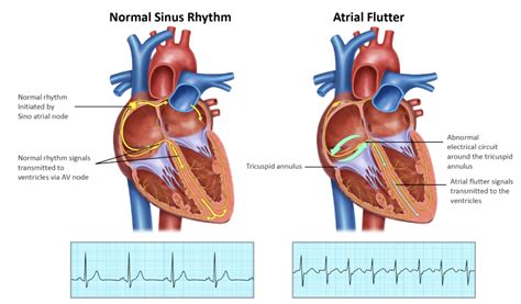 Atrial Flutter Melbourne Heart Group