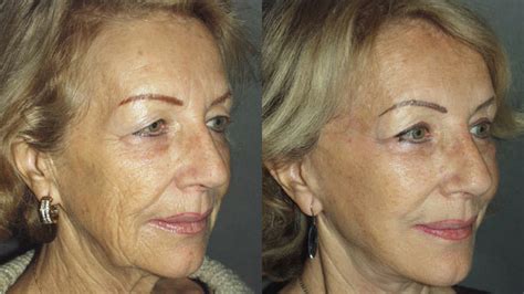 Lifting cervico facial ou lifting du cou Chirurgie esthétique visage