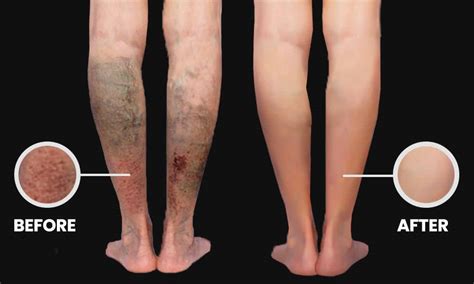 Venous Ulcers Ivein Clinic