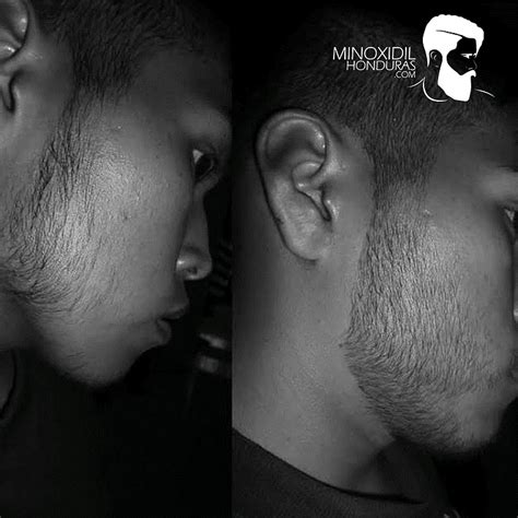 Resultados Obtenidos Con Minoxidil Para La Barba Minoxidil Honduras