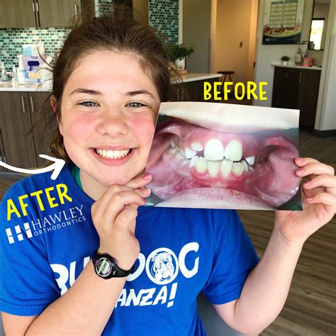How Can Invisalign And Braces Change Your Face Shape Hawley Orthodontics