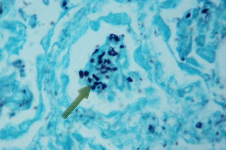 VA Clinical Public Health Programs HIV AIDS Pneumocystis Jiroveci