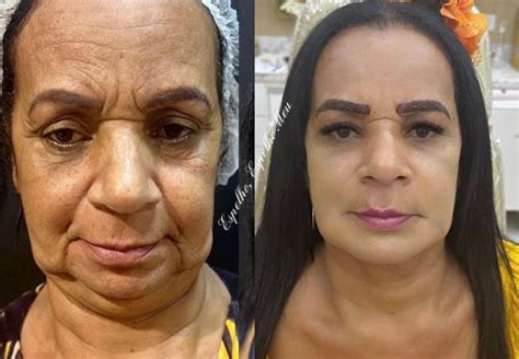Sucesso no Pânico Gaga de Ilhéus faz harmonização Facial veja antes e