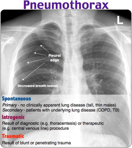 Pneumothorax Flashcards Quizlet