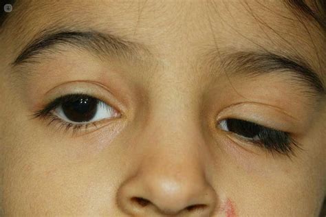 Ptosis Palpebral O P Rpado Ca Do Qu Es Causas Y Tratamiento