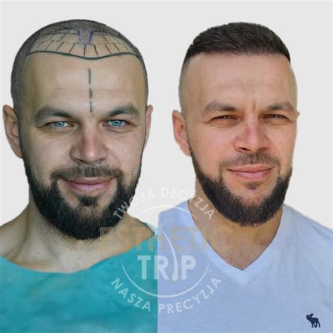 Przeszczep W Os W Wy Sza Jako Ni Sza Cena Turcja