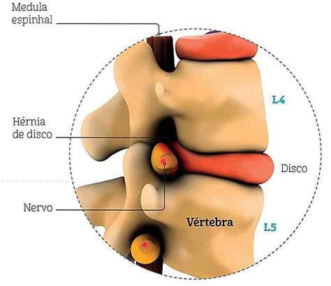 Dolor en la lumbar Qué puede ser causas y cómo tratar es