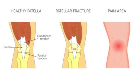 Patella Fracture Types Causes And Treatment Zealmax Innovations Pvt Ltd