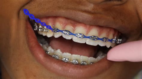 Watch BEFORE Getting POWER CHAIN On Your Braces YouTube