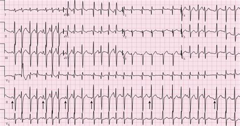 Solved Activity ECG Worksheet Use The Picture Below To Chegg