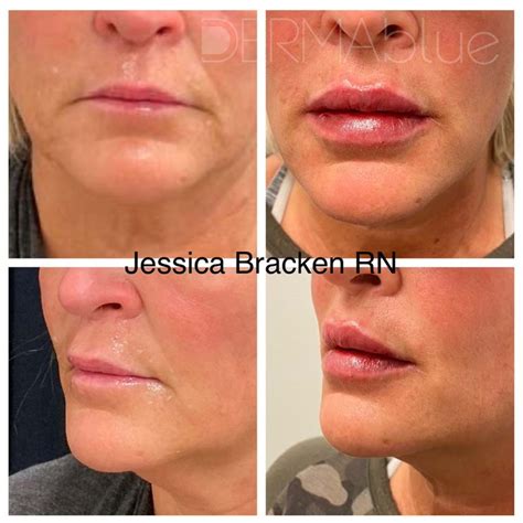 Realistic Ml Lip Filler Before And After Thin Lips Stunning