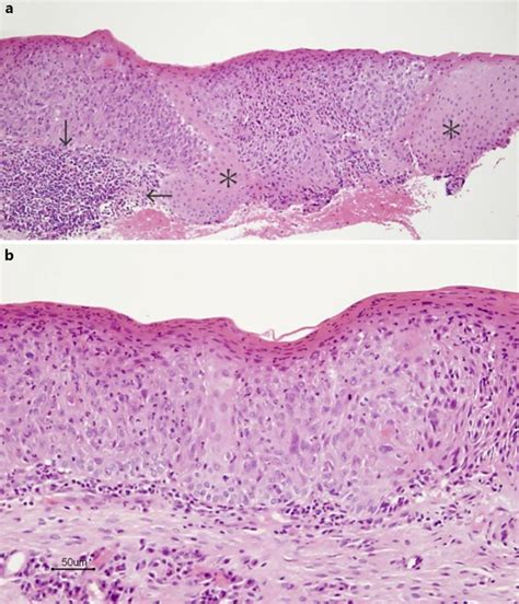 Follicular Conjunctivitis Histology