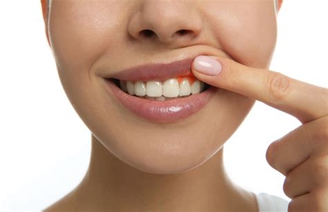 Síntomas de la infección dental Cuándo se necesita una endodoncia