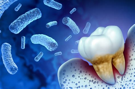La Periodontitis Causas S Ntomas Factores De Riesgo Y Tratamiento