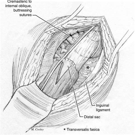 8 Learning Curve Of Robotic Inguinal Hernia Repair R TAPP In The