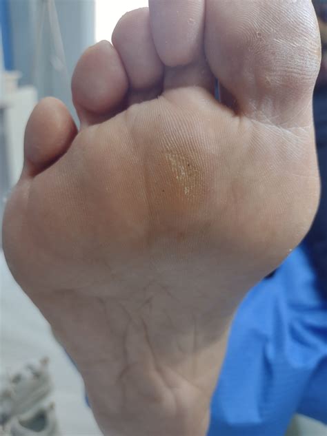 Hiperqueratosis y Helomas qué son Podovita Cliníca del Pie Lola
